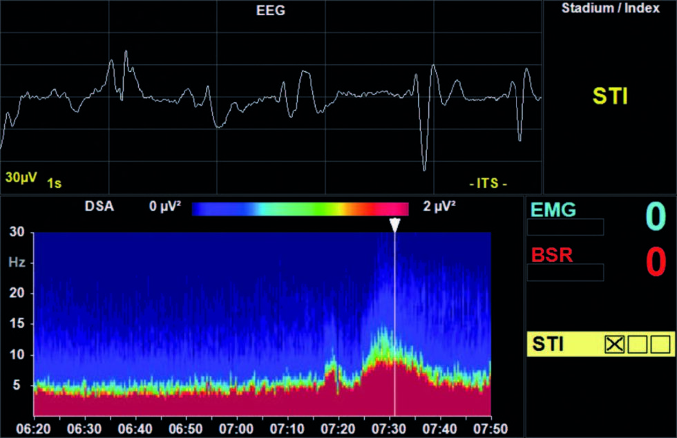 Kontinuierliche EEG-Überwachung bei beatmeten Patienten mit COVID-19 ...