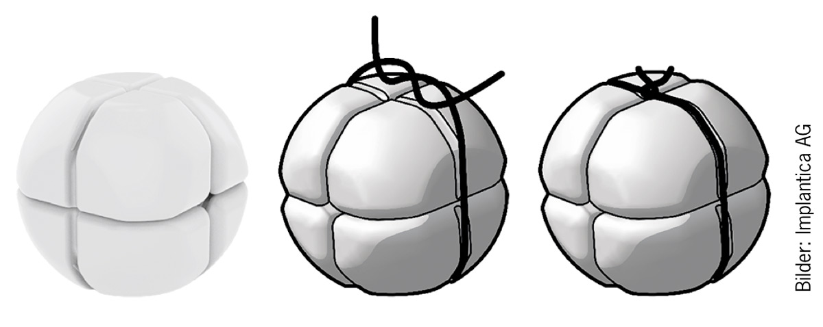 Eine neue minimal-invasive Behandlungsmethode in der Anti ...