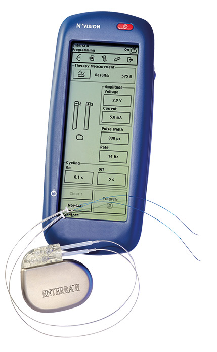 Die Enterra Therapie:Behandlung von Gastroparese sowie assoziierter ...